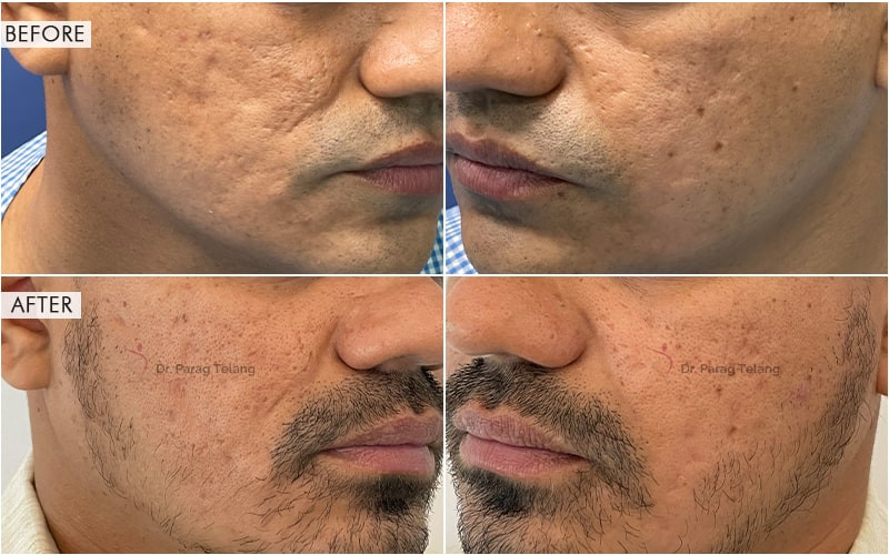 Nano-fat Grafting Nano-fat Grafting